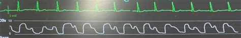 Non Intubated Patient Etco2 Waveform With A Notch At The End Rems