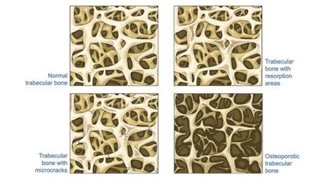 Bone Quality Index Bone Structure And Osteoporosis