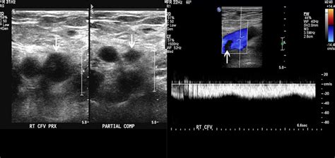Trombosis Venosa Profunda Cardiología Manual Msd Versión Para