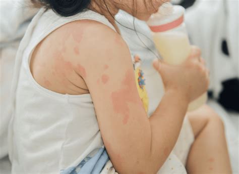Your Guide To Clothing Dermatitis Nylon Nickel Latex And More The