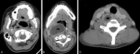 A B C Axial Computed Tomography Ct Scan Of The Neck Showed