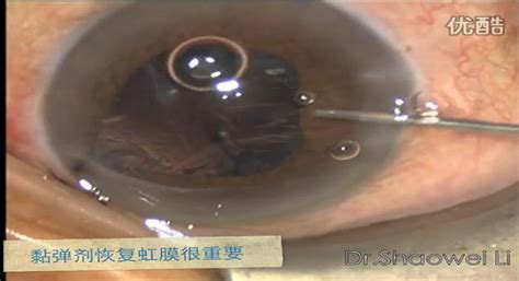 屋漏偏早连夜雨：一例水分离出现房水迷流 好医术文章 好医术 赋能医生守护生命