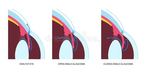Glaucoma Eye Disease Stock Vector Illustration Of Cornea 329567726