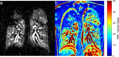 Functional Pulmonary Imaging Kern Journal Of Magnetic Resonance