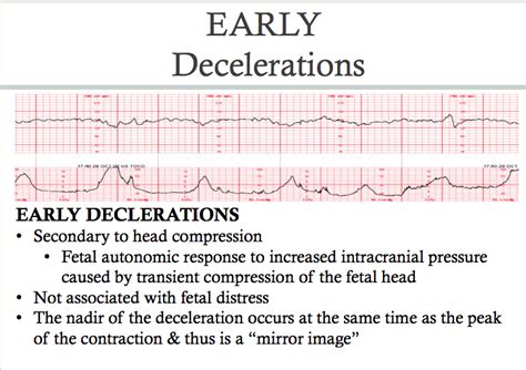 Early Decelerations
