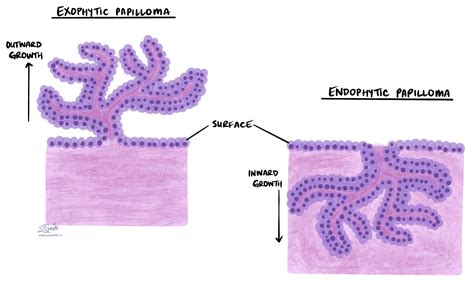 Vad är Ett Papillom Minpathologyreport