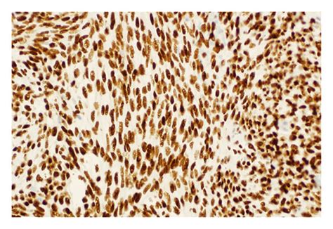 Histology Of Synovial Sarcoma And Immunohistochemical Staining For