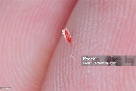 Splinter In Finger A Sharp Small Piece Of Wood Driven Into The Skin Of