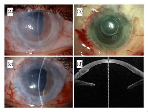 A Preoperative Image Aphakic Eye With A Failed Dsaek B Appearance