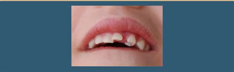 Dental First Aid For A Dislodged Tooth Downloadable Guide