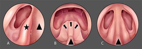 Pdf Laryngoscope 128 July 2018 Choby And Nayak Crosscourt Draf
