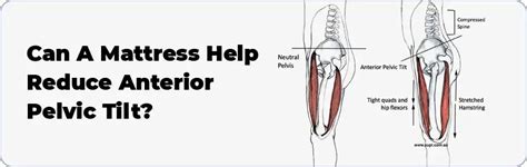 6 Best Mattresses To Fix Anterior Pelvic Tilt