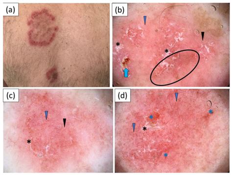 Dermoscopic Features Of Acute Subacute Chronic And Intermittent