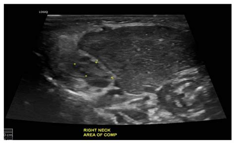 Ectopic Thymus In Newborn A Case Report