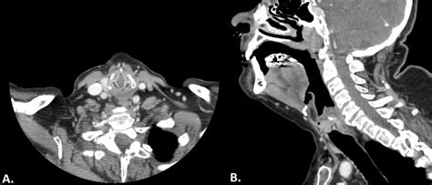 Subacute Epiglottitis Causing Polypoid Laryngeal And Glottic Masses