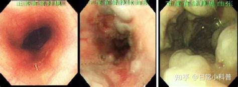 徐克成大讲堂 门静脉高压症食管胃静脉曲张，你了解吗？ 知乎