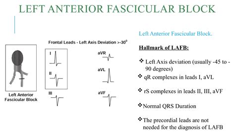 Intraventricular Conduction Block Pptx