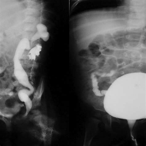 Filling Cystourethrogram Right Vesicoureteral Reflux Vur To The