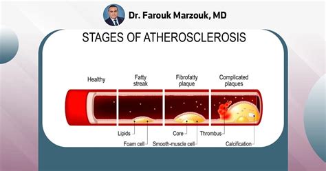 Medical Management Of Atherosclerosis Vascular Disease