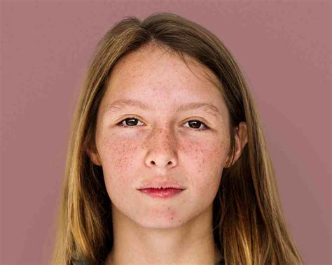 Top 12 Creams For Melasma Recommended By Dermatologists Credihealth