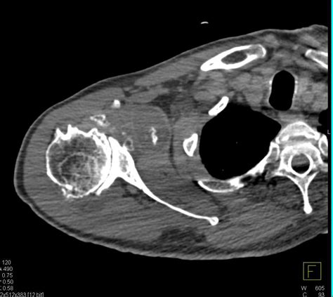Degenerative Joint Disease Djd Shoulder With Large Joint Effusion