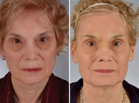 Patient 990865 Laser Skin Resurfacing Before And After Photos W Cosmetic Surgery