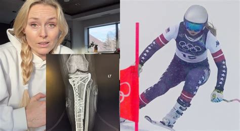 Lindsey Vonn Reveals How Torn Acl May Have Actually Saved Her Leg From