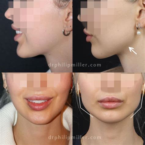 The Advantages Of Using Customized Facial Implants Philip Miller Md