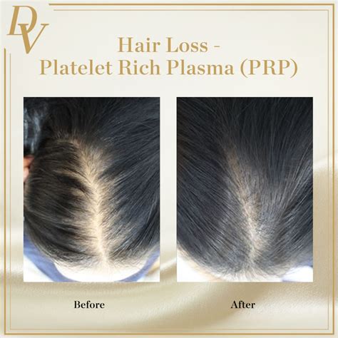 Platelet Rich Plasma Prp Da Vinci Clinic