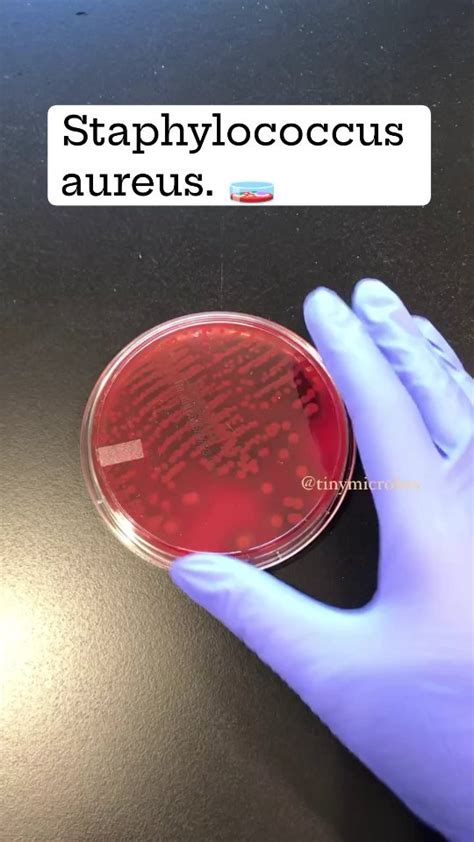 Staphylococcus Aureus Sintomas