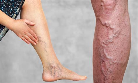 Medfin Blogvaricose Veins Vs Spider Veins Whats The Difference
