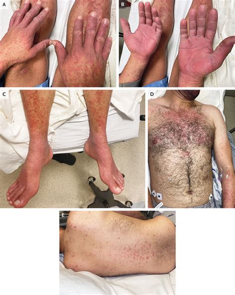 Maculopapular Rash Syphilis