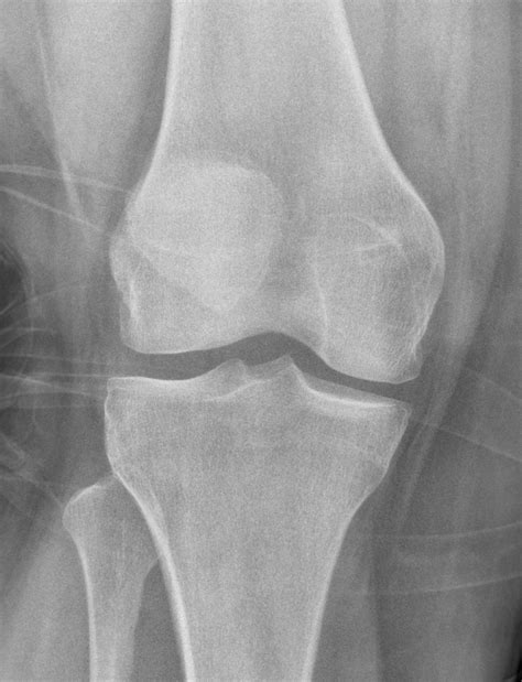 Lateral Patellar Dislocationsliver Sign Radiology Article