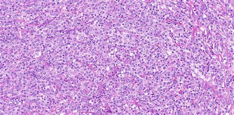 Immunohistochemical Staining 200× Magnification Of Lymphoma Cells Was Download Scientific