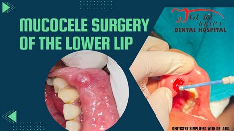 Mucocele Surgery Of The Lower Lip Youtube