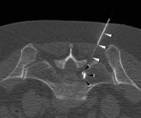 Ct Guided S1 Nerve Root Injection The Black Arrowheads Indicate The