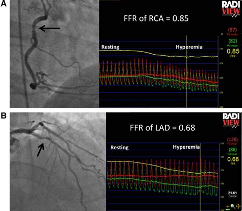 Figure 2 From Fractional Flow Reserve Guided Percutaneous Coronary