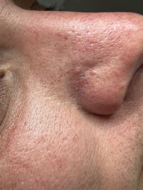 What Are Fibrous Papules And How Can Diathermy Help
