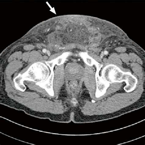 Contrast Enhanced Computed Tomography Scan Diffuse Soft Tissue Download Scientific Diagram