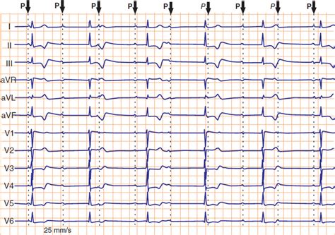 Third Degree Av Block Ecg