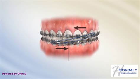 Anterior Cross Elastics Youtube