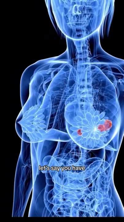 [video] Chett Heitman On Linkedin Healthinsurancecoverage Medicalbillrelief