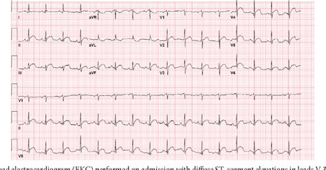 Figure 1 From Hypercalcemia Induced St Segment Elevation Mimicking