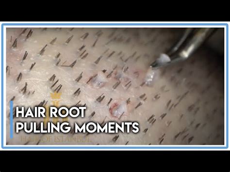 Human Hair Follicle Pulled Out