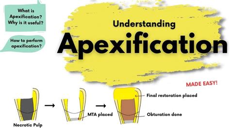 Apexification What Is It Endodontics In 2025 Endodontics