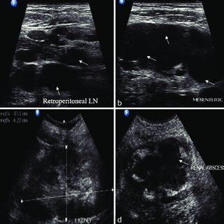 A Enlarged Hypoechoic Arrow Retroperitoneal Lymph Nodes B