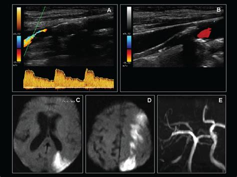 A Typical Example Of Cerebral Watershed Infarct Pmc
