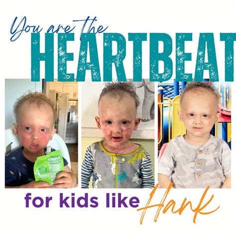 National Foundation For Ectodermal Dysplasias On Linkedin Hey Everyone Hank Here You Know