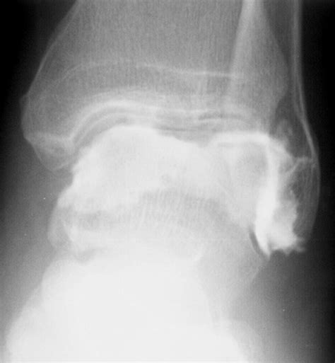 Emergency Joint Aspiration A Guide For Radiologists On Callradiographics