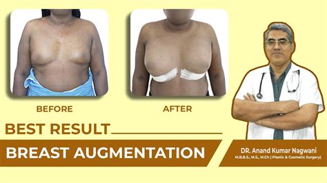 Breast Implant Before And After Result Silicon Breast Implant 30 Yrs